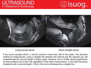 How to measure cervical length | PPT