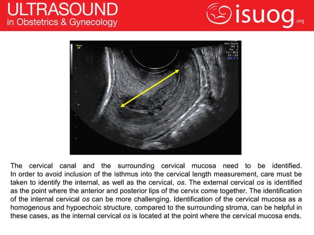 How to measure cervical length