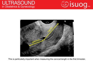 How to measure cervical length | PPT