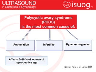 UOG Journal Club: Polycystic ovaries at ultrasound: normal variant or ...
