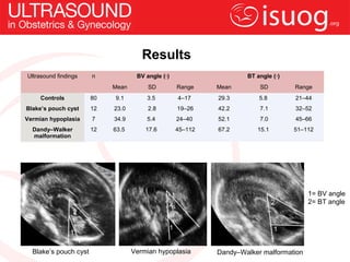 UOG Journal Club: Prenatal diagnosis and outcome of fetal posterior ...