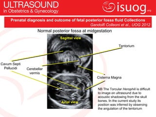 UOG Journal Club: Prenatal diagnosis and outcome of fetal posterior ...