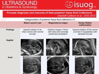 UOG Journal Club: Prenatal diagnosis and outcome of fetal posterior ...