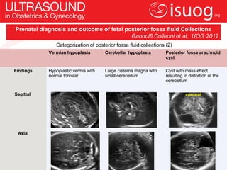 UOG Journal Club: Prenatal diagnosis and outcome of fetal posterior ...