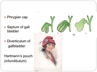Gallbladder Anatomy Hartmann Pouch