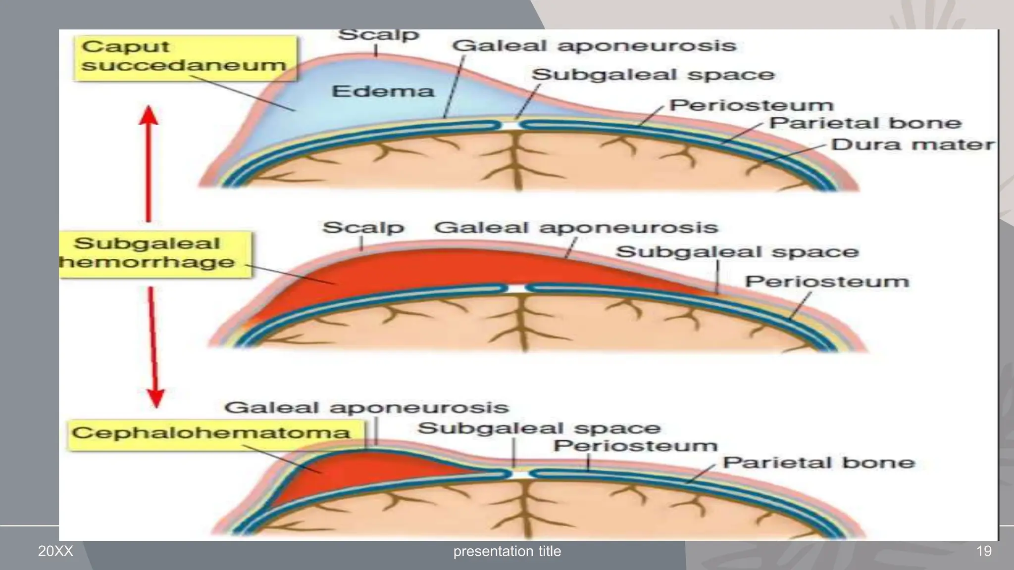 UPASHEERSHAKA - caput succedaneum / cephalohematoma | PDF