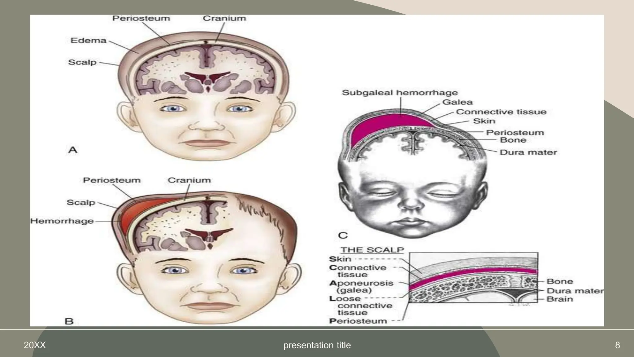 UPASHEERSHAKA - caput succedaneum / cephalohematoma | PDF