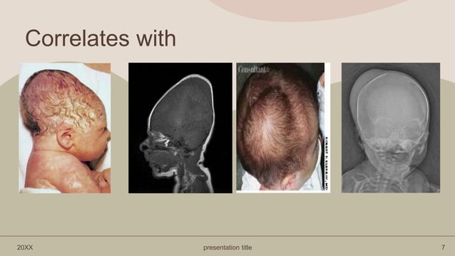 UPASHEERSHAKA - caput succedaneum / cephalohematoma | PDF | Pregnancy ...