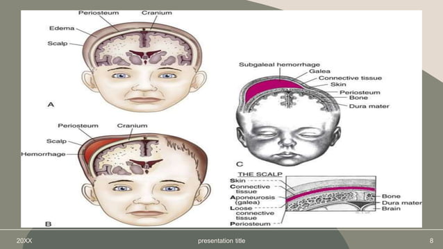 UPASHEERSHAKA - caput succedaneum / cephalohematoma | PDF | Pregnancy ...