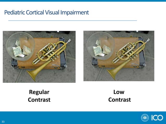 AAO: Pediatric Cortical Visual Impairment | PPTX