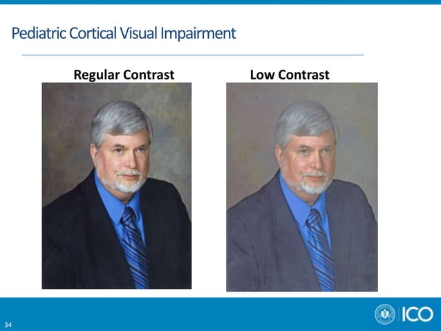AAO: Pediatric Cortical Visual Impairment | PPTX