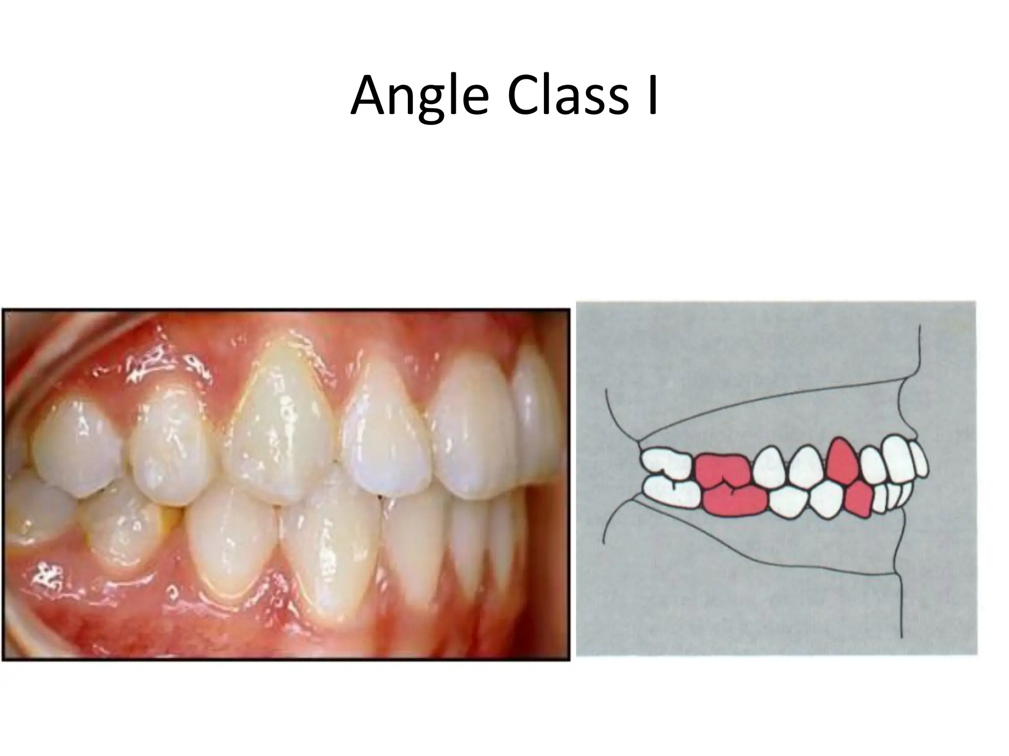 update Classification of Malocclusion- updated.pdf