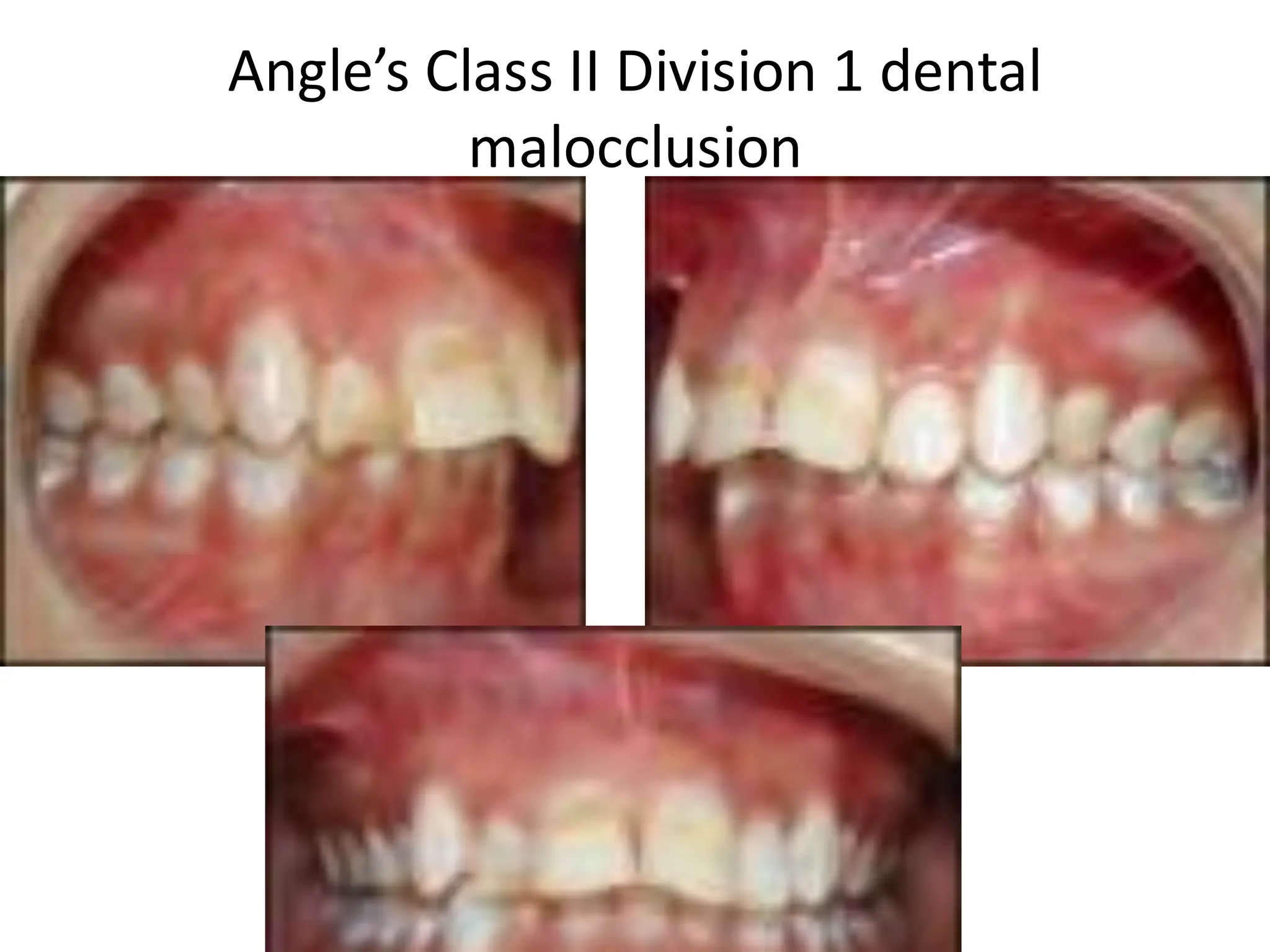 update Classification of Malocclusion- updated.pdf
