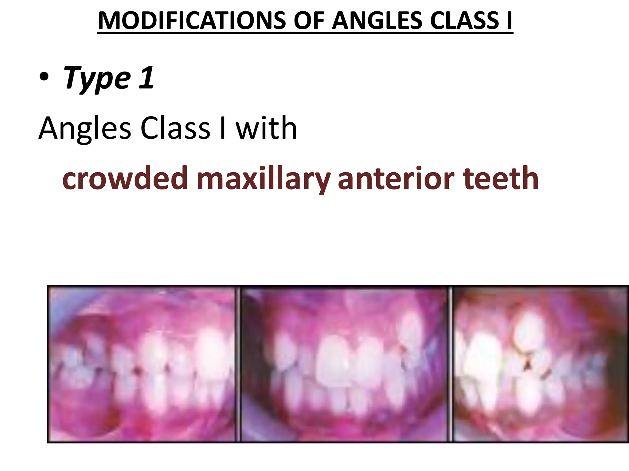 update Classification of Malocclusion- updated.pdf
