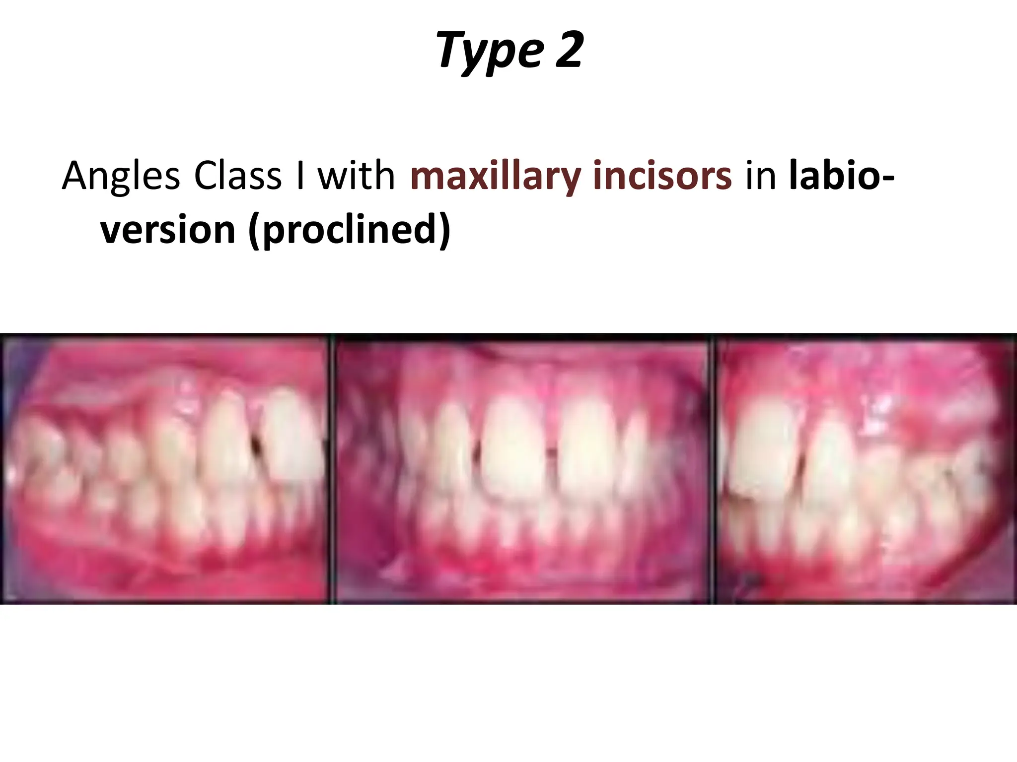 update Classification of Malocclusion- updated.pdf