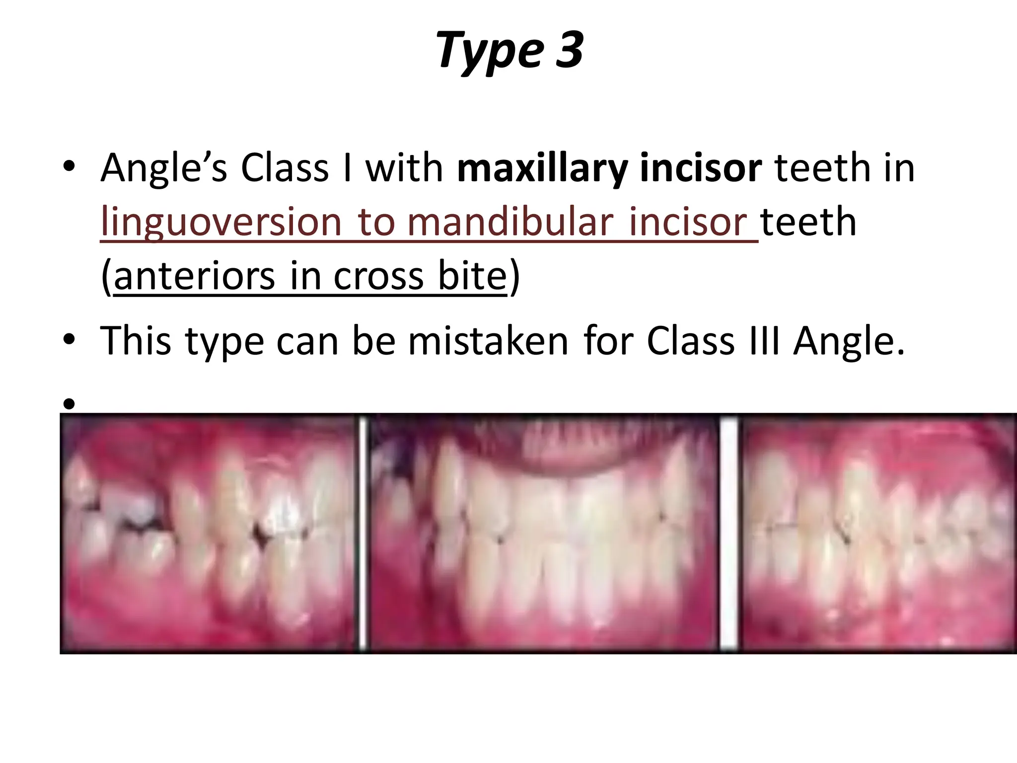 update Classification of Malocclusion- updated.pdf