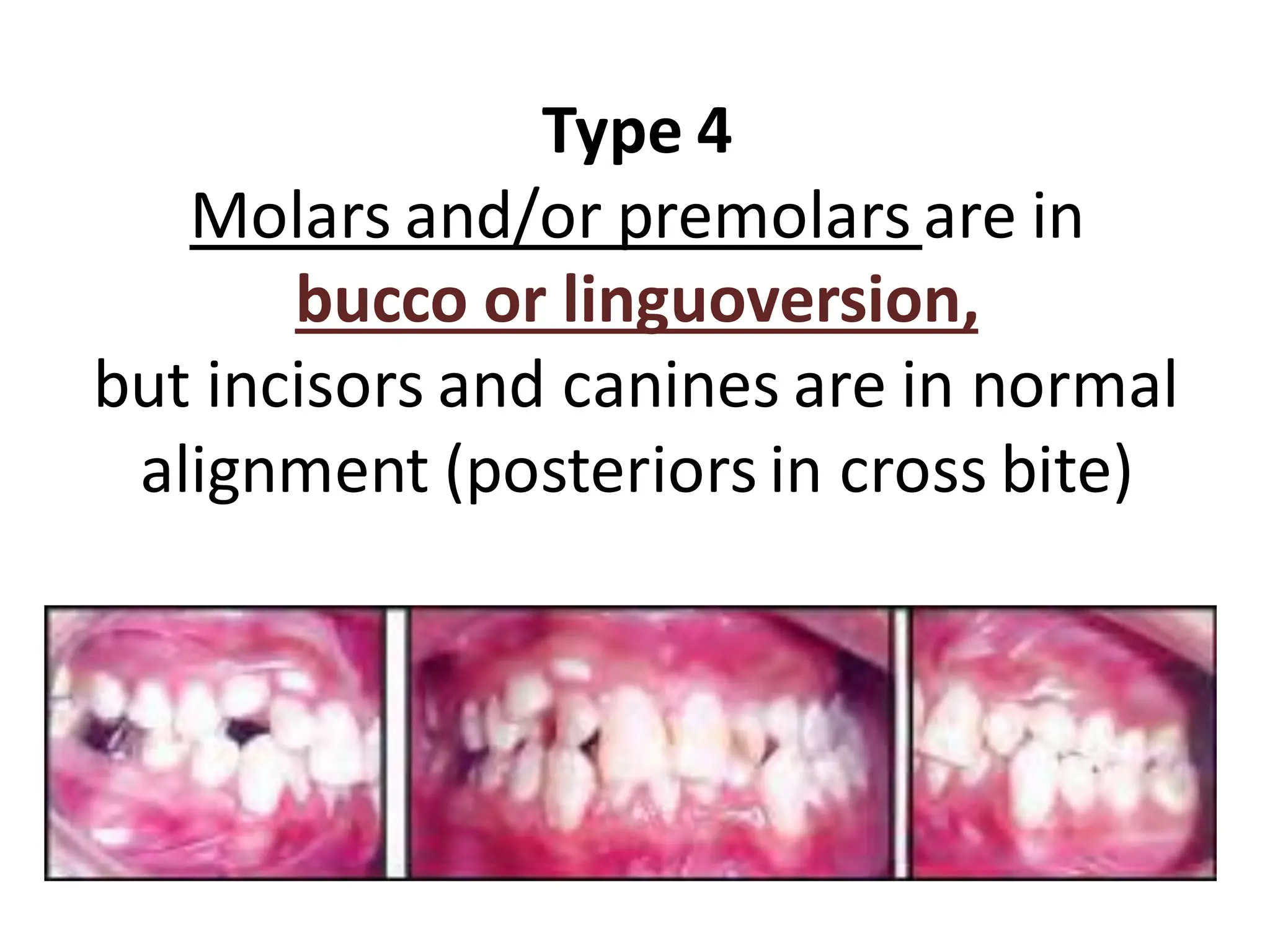 update Classification of Malocclusion- updated.pdf