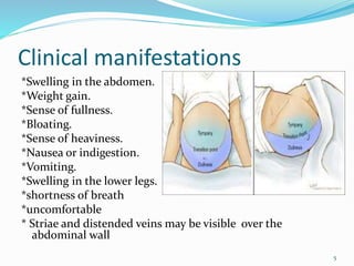 Ascites definition, causes, clinical manifestations,diagnosis .pptx