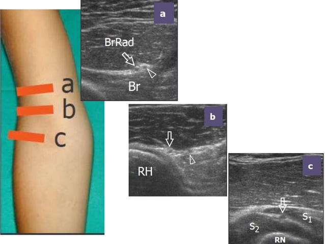 Updated Elbow Musculoskeletal US Examination | PPTX