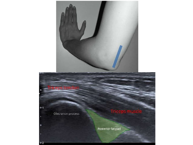 Updated Elbow Musculoskeletal US Examination | PPTX