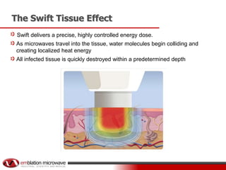 Emblation Microwave | PPTX | Medical Health