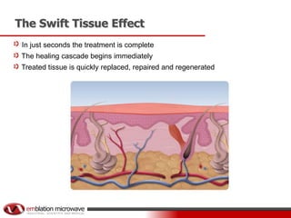 Emblation Microwave | PPTX | Medical Health
