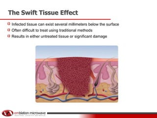 Emblation Microwave | PPTX | Medical Health