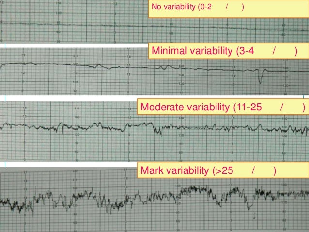 Updated intrapartum monitoring