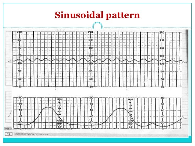 Updated intrapartum monitoring