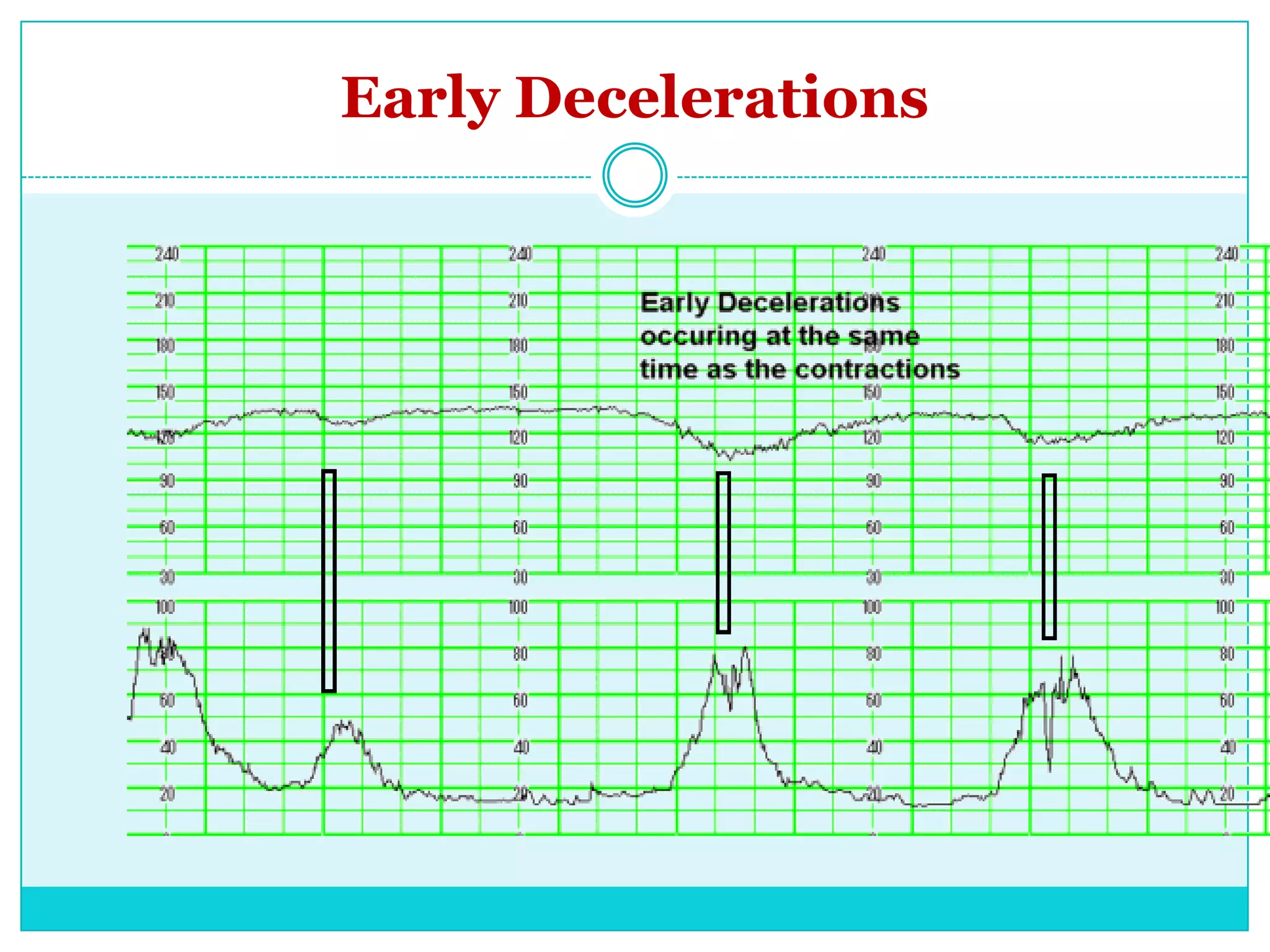Updated intrapartum fetal monitoring | PPTX