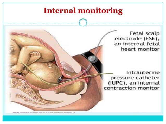 Updated intrapartum fetal monitoring | PPTX