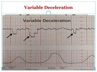 Updated intrapartum fetal monitoring | PPTX