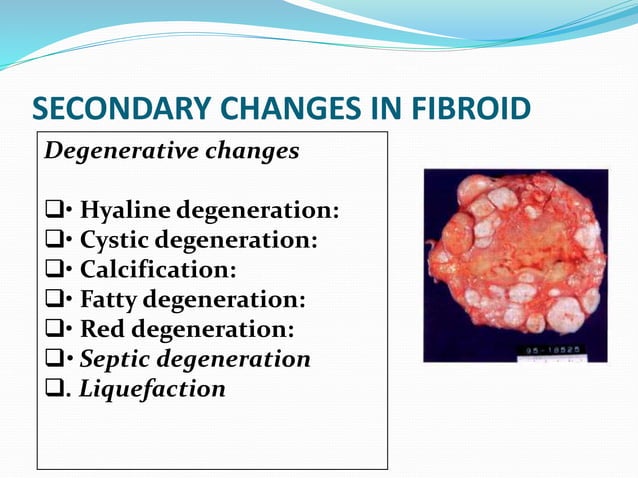 Updated mx of ut fibroids | PPT