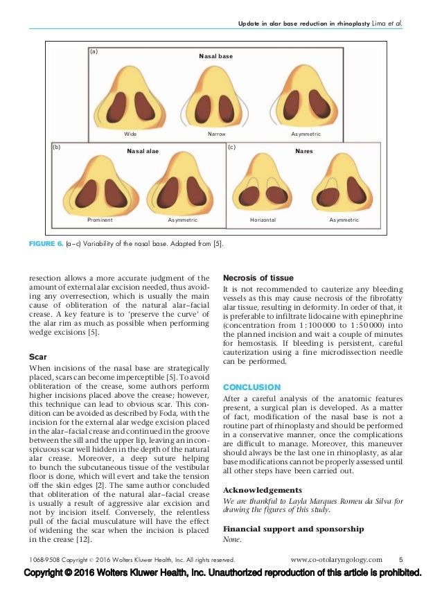 Update in alar base reduction in rhinoplasty