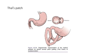 Updates in peptic ulcer disease | PPTX
