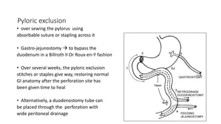 Updates in peptic ulcer disease | PPTX