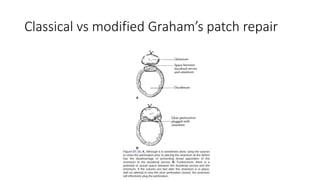 Updates in peptic ulcer disease | PPT