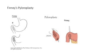Jaboulay Pyloroplasty