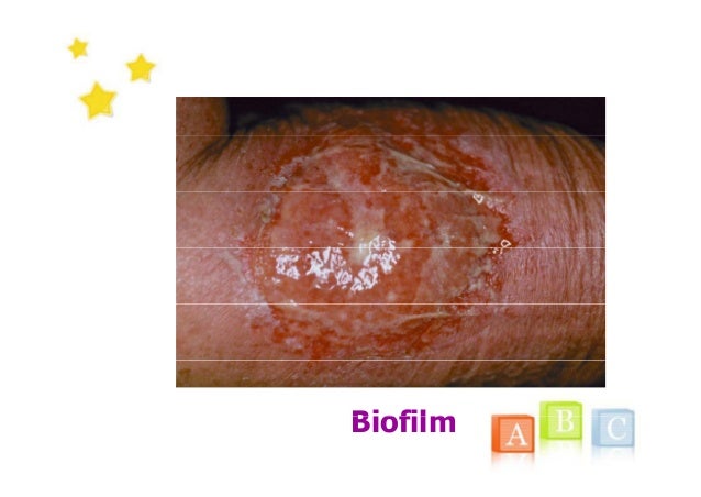 biofilm on wound bed