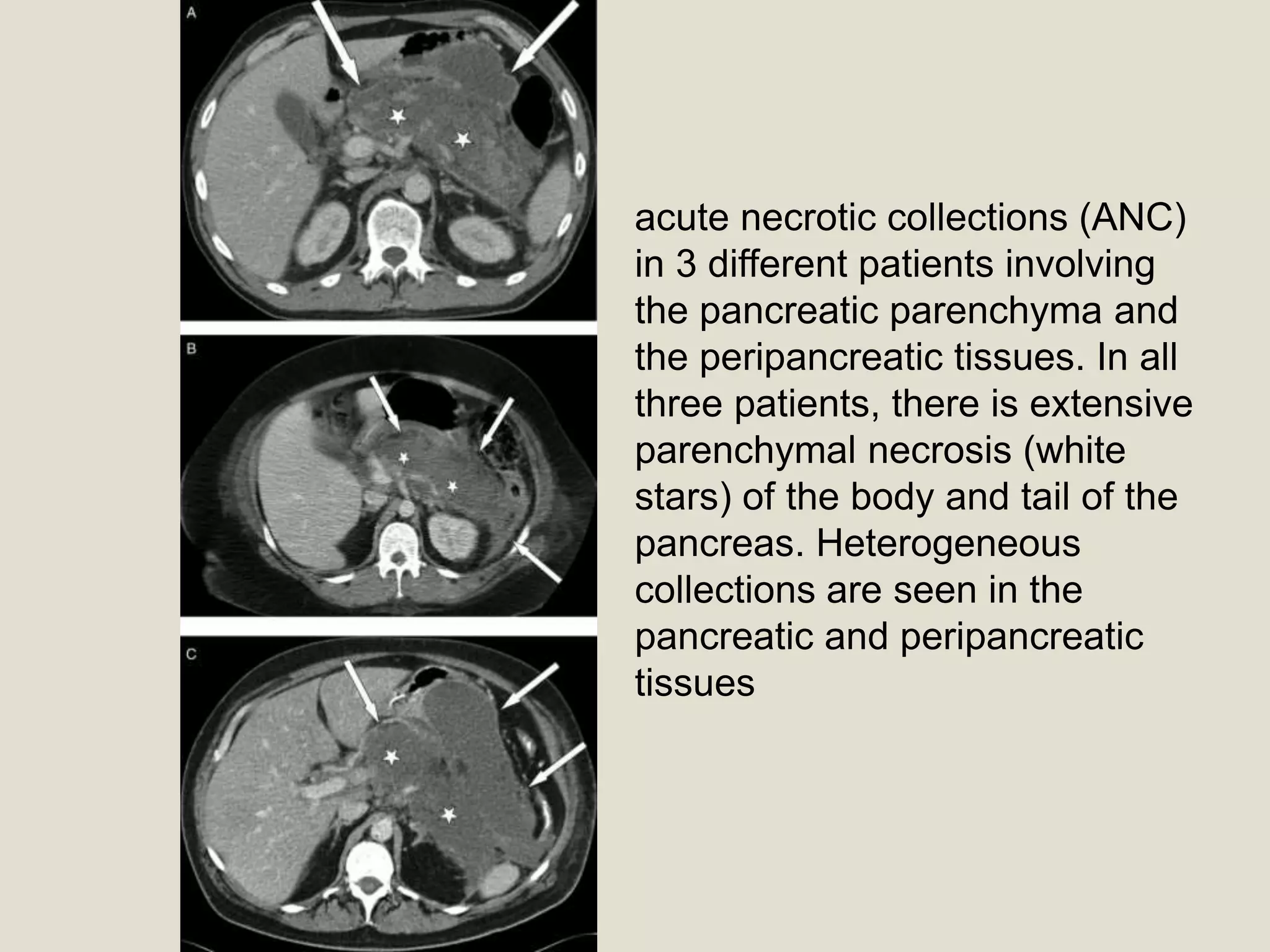 Update of atlanta classification of acute pancreatitis published | PPTX