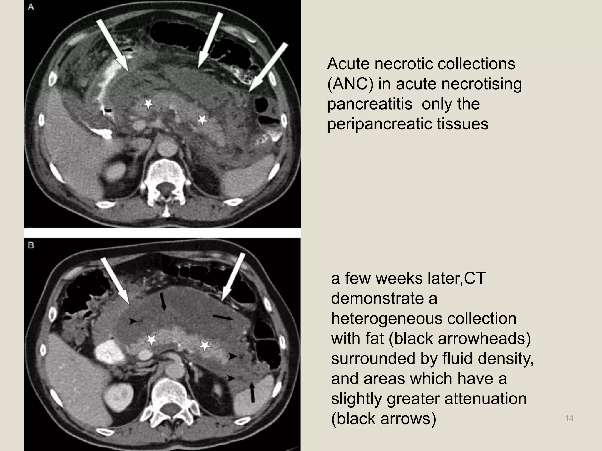 Update of atlanta classification of acute pancreatitis published | PPTX