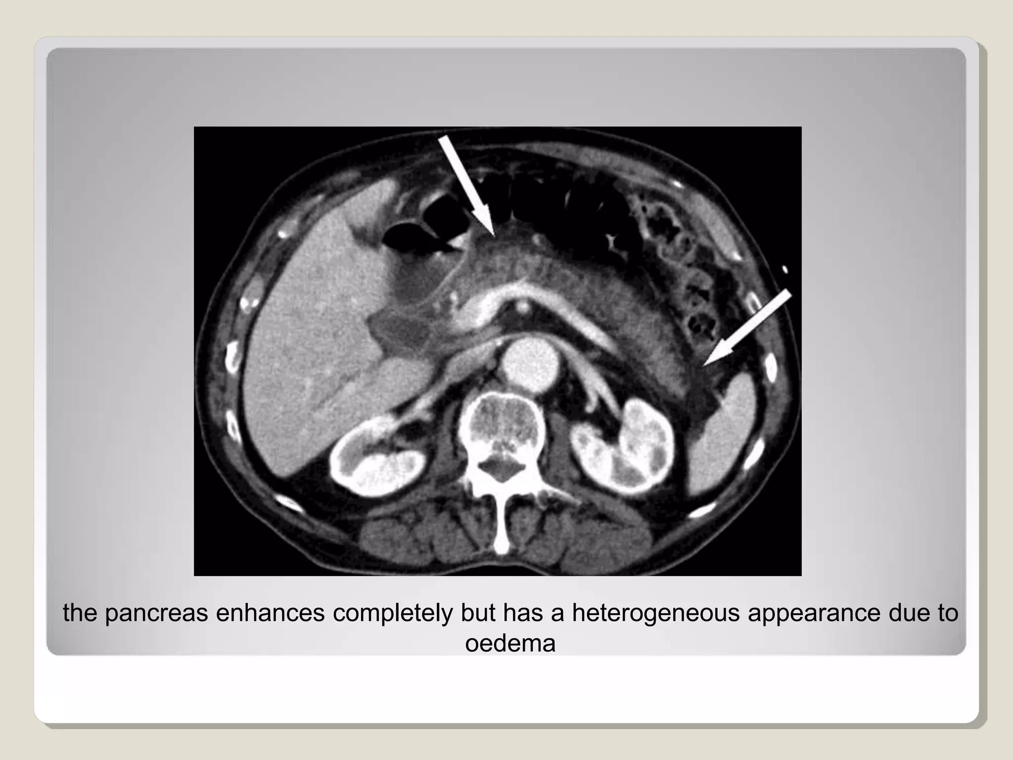 Update of atlanta classification of acute pancreatitis published | PPTX