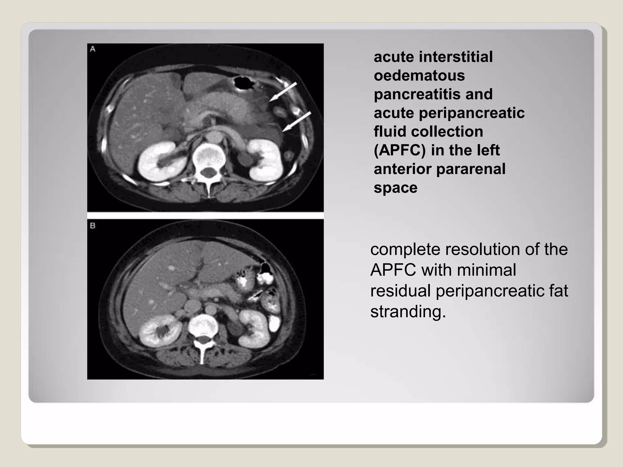 Update of atlanta classification of acute pancreatitis published | PPTX