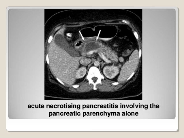 Update of atlanta classification of acute pancreatitis published