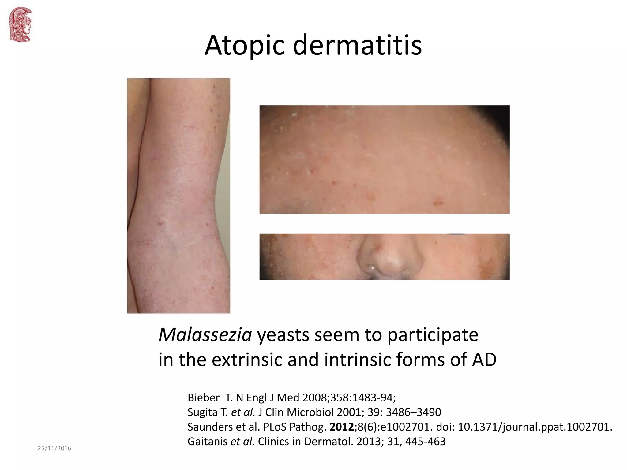 Update on malassezia associated skin diseases1 | PDF