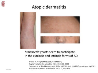 Update on malassezia associated skin diseases1 | PDF