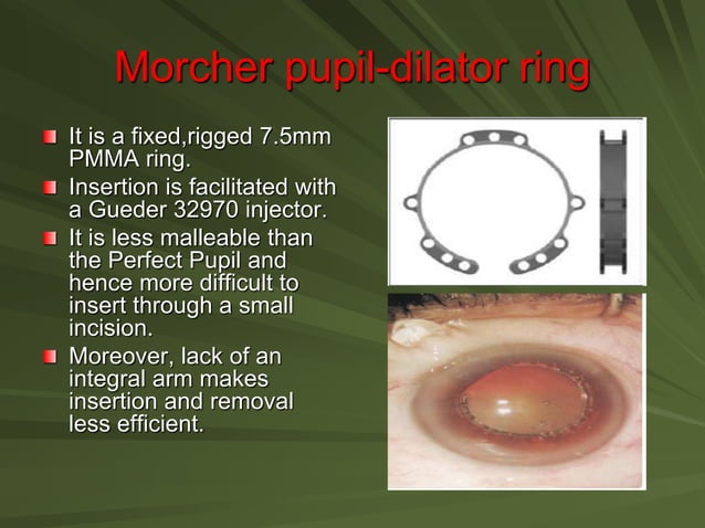 Update on pupil stretching and capsular stabilization devices | PPT