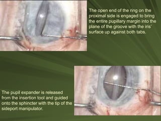 Update on pupil stretching and capsular stabilization devices | PPT