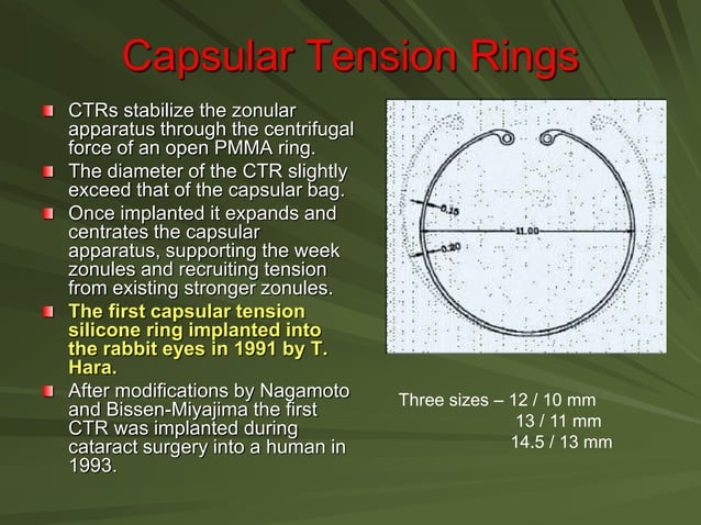 Update on pupil stretching and capsular stabilization devices | PPT