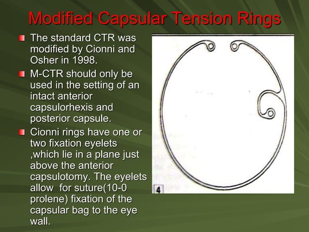 Update on pupil stretching and capsular stabilization devices | PPT